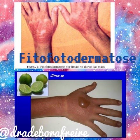 Consultório Dra. Débora Freire » Fitofotodermatose